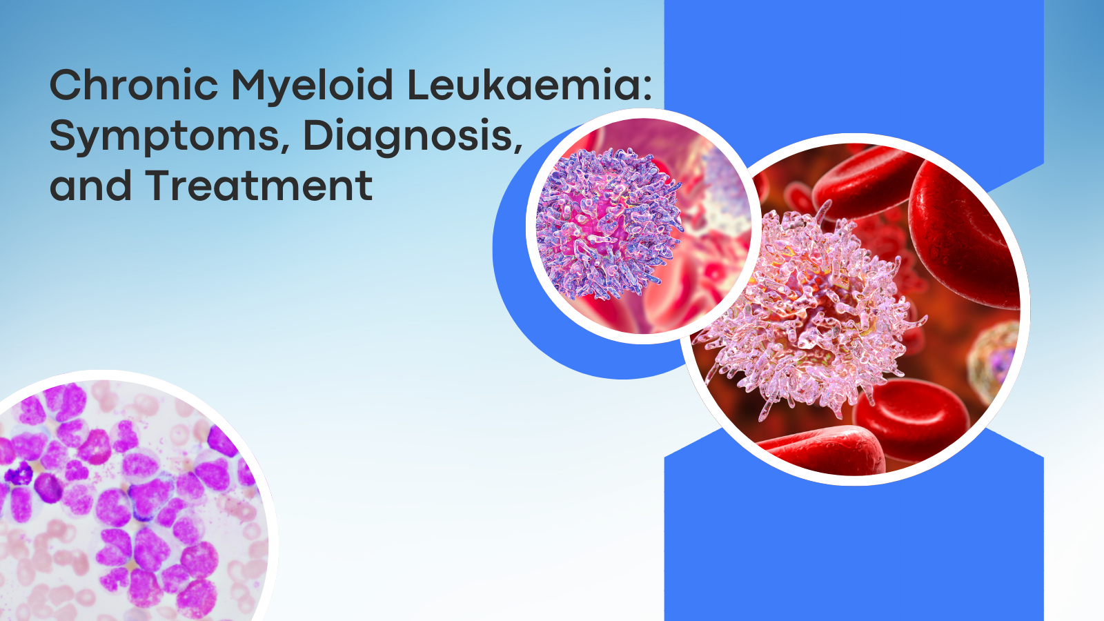Chronic Myeloid Leukaemia: Symptoms, Diagnosis, and Treatment